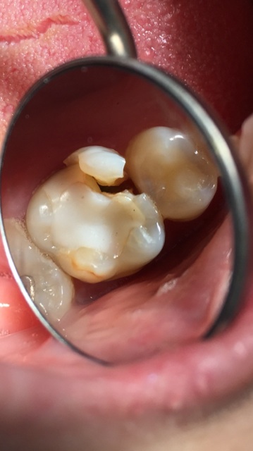 Fractured teeth of the day. Every day I see broken teeth. Here are 2 ...