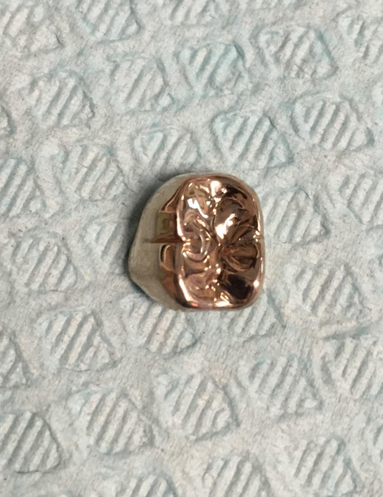 Retention Grooves to help crowns last longer. | Dr. Gentry