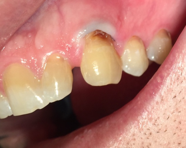 cavities-before/after | Dr. Gentry | Page 2