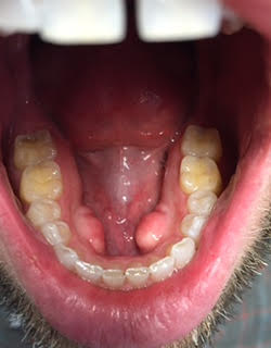 mandibular tori | Dr. Gentry