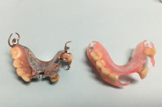 partial dentures-before/after | Dr. Gentry