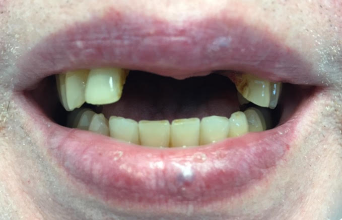 immediate partial denture | Dr. Gentry