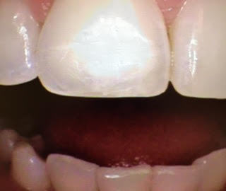 chipped teeth-before/after | Dr. Gentry