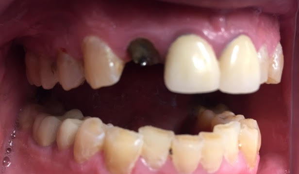 post and core build-up | Dr. Gentry