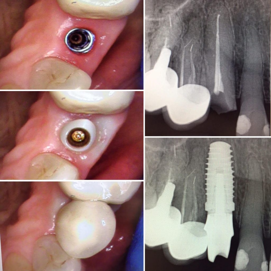 Dental implant case of the day | Dr. Gentry