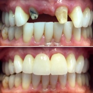 bridges to replace missing teeth | Dr. Gentry