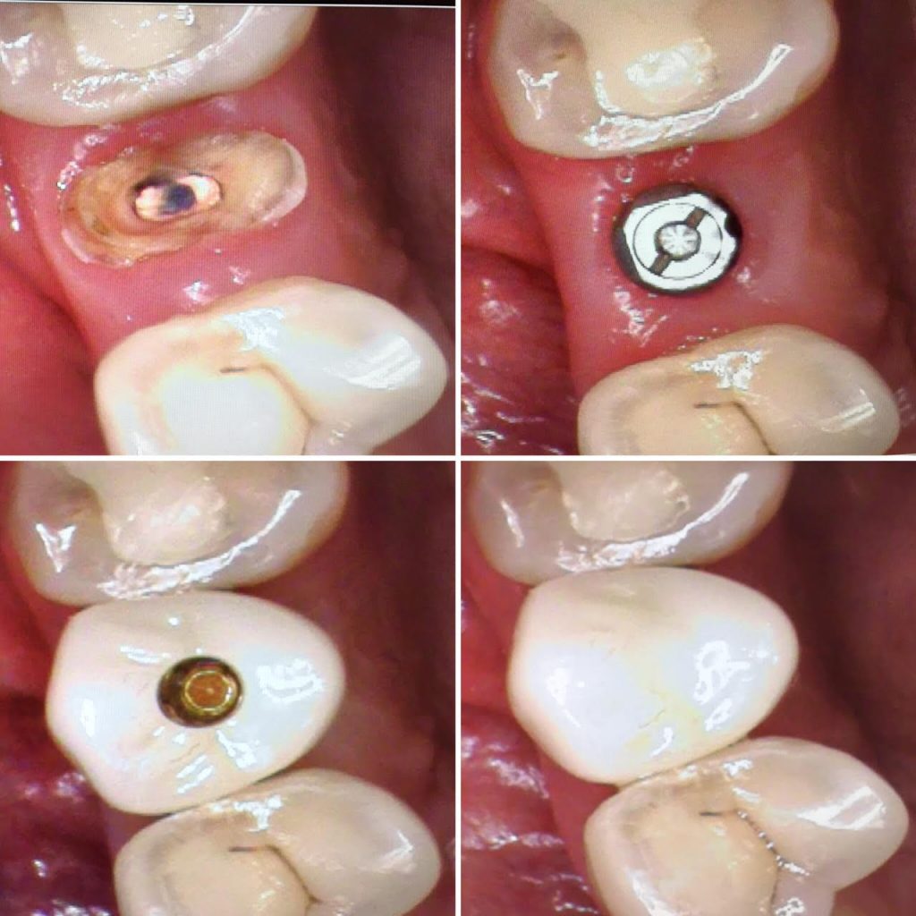 Dental Implant Case of The Day | Dr. Gentry