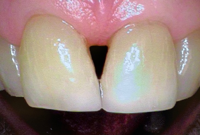 chipped teeth-before/after | Dr. Gentry