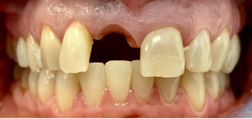bridges to replace missing teeth | Dr. Gentry